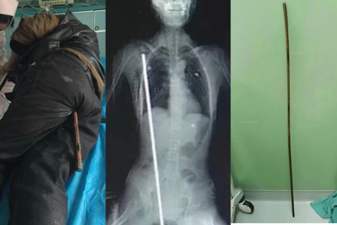 Worker Survives 2-Foot Rod Through Body: A Medical Miracle - HypeFresh Inc